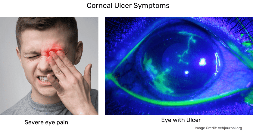 Eye Ulcer Treatment in Mumbai - Dr Anurag Agarwal Eye Clinic