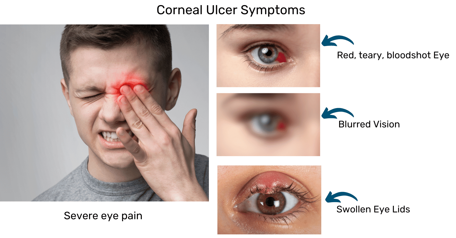 Eye Ulcer Treatment In Mumbai Dr Anurag Agarwal Eye Clinic