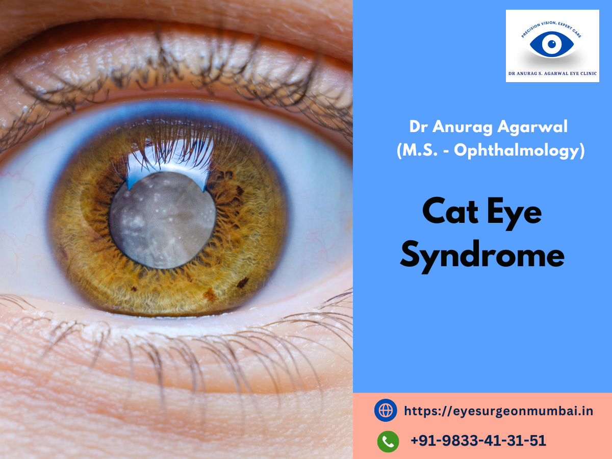 Cat Eye Syndrome Treatment in Mumbai - Dr Anurag Agarwal